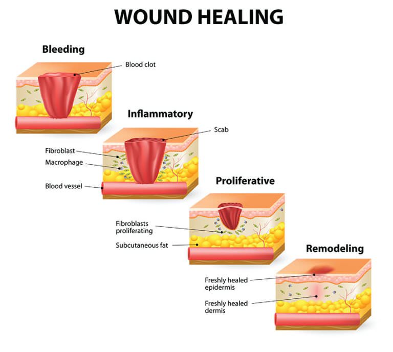 Stages of Healing - What Happens When You Injure Yourself